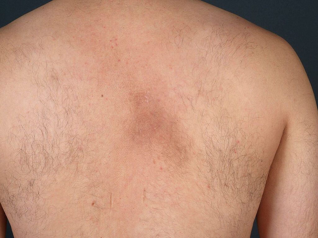 Completed trials - Zia-Derm